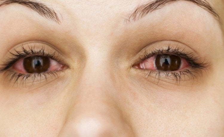 Suzne oči – uzroci, simptomi, liječenje | Kreni zdravo!