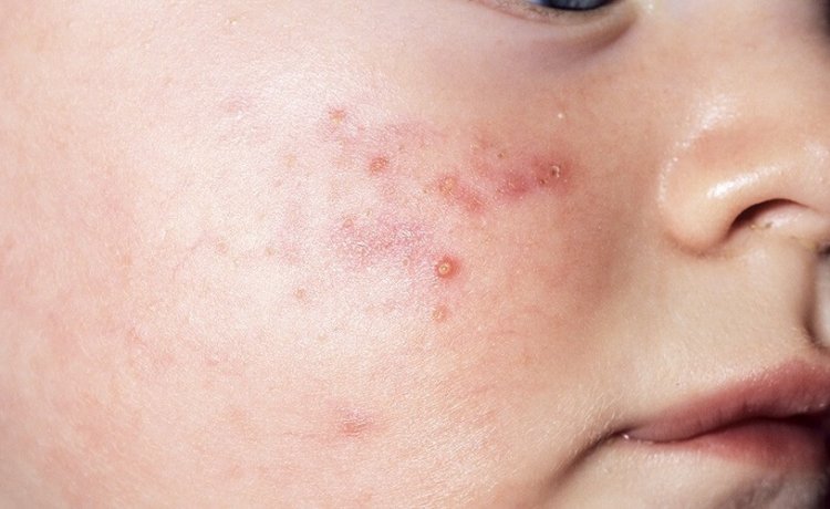 Bivacyn mast – Uputa o lijeku | Kreni zdravo!