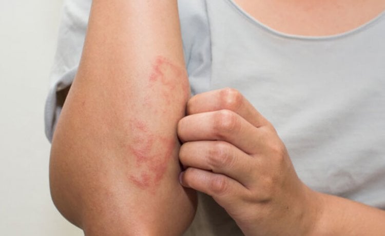 Alergijski dermatitis – uzroci, simptomi i liječenje | Kreni zdravo!