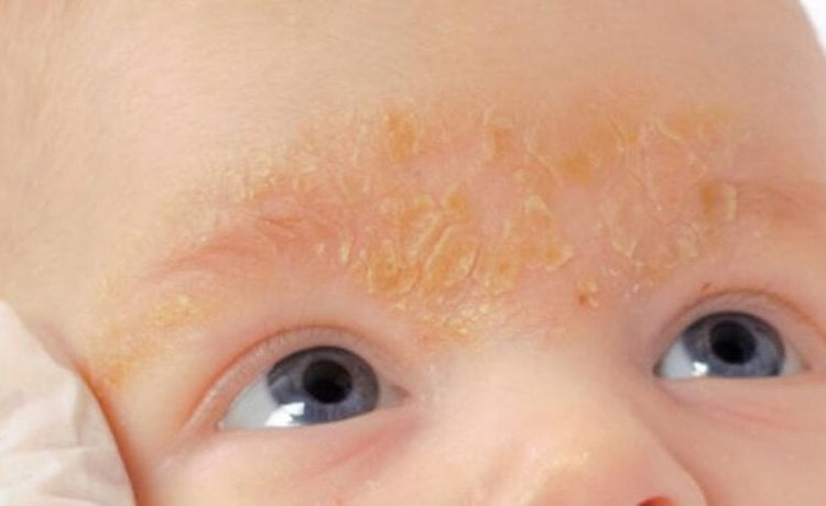 Beloderm krema – Uputa o lijeku | Kreni zdravo!