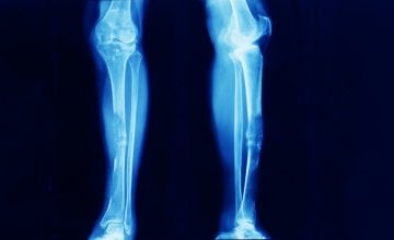 Rak kostiju: Ovo su simptomi bolesti od koje je preminuo Jasmin Stavros ...