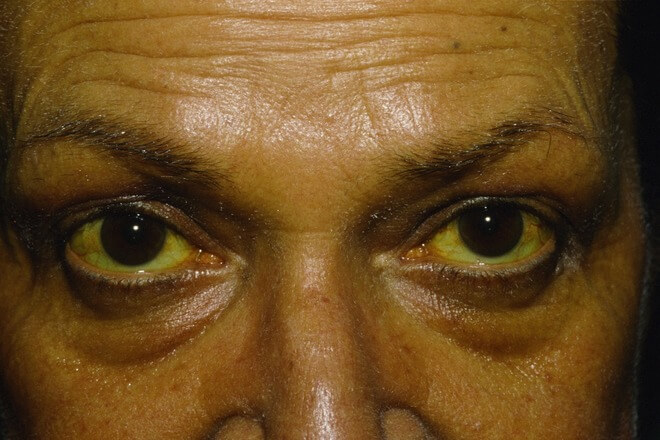 Žutica – kako ju prepoznati i izliječiti? | Kreni zdravo!