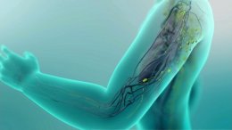 Limfedem – uzroci, simptomi i liječenje | Kreni zdravo!