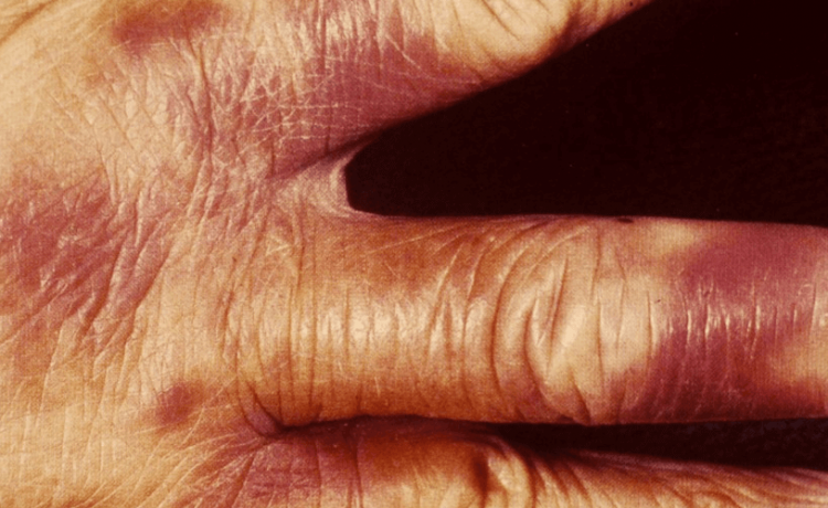 Urifos granule za oralnu otopinu (2 g, 3 g) – Upute o lijeku | Kreni ...