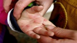 Koksaki virus (bolest prljavih ruku) – uzroci, simptomi i liječenje ...