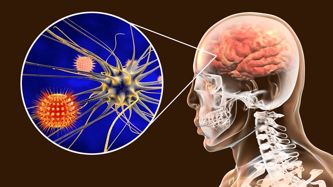 Virusni meningitis | Kreni zdravo!