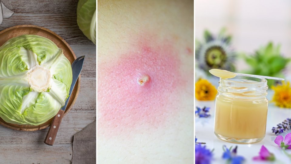 Sve o Temi apsces kože | Kreni zdravo!