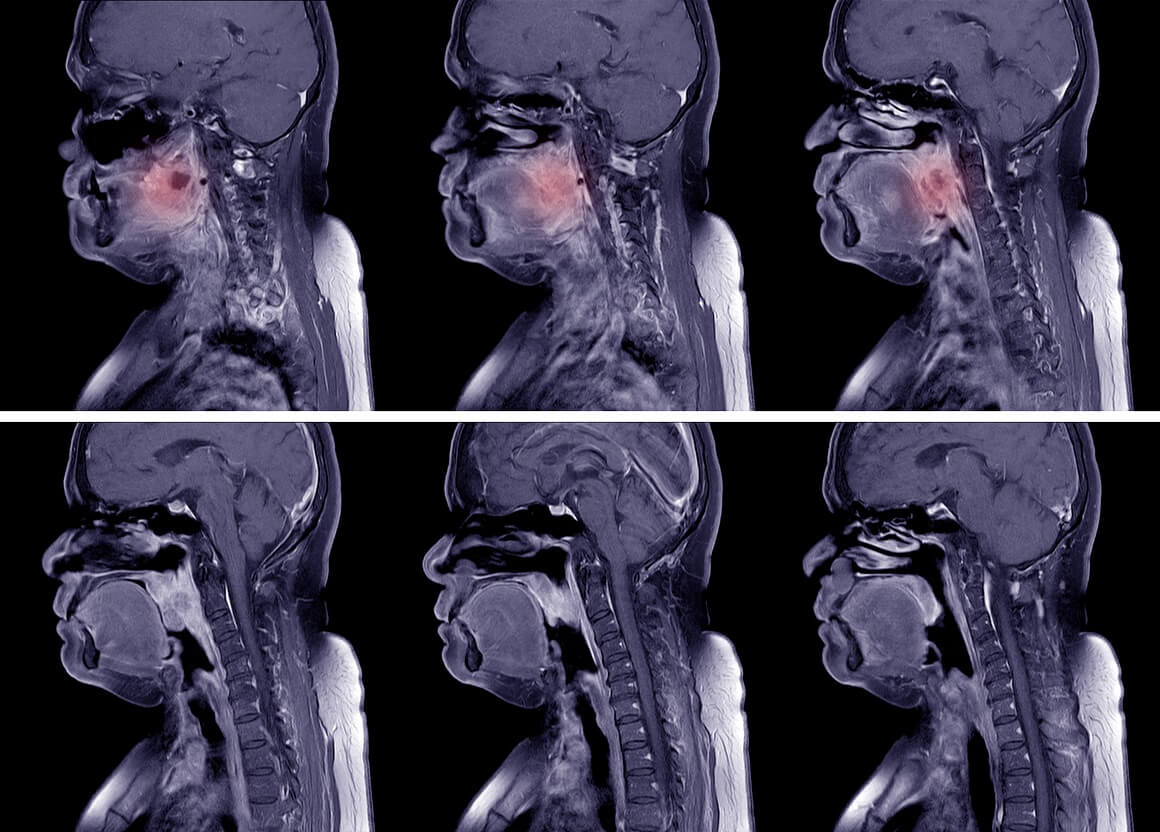 Karcinom orofarinksa | Kreni zdravo!